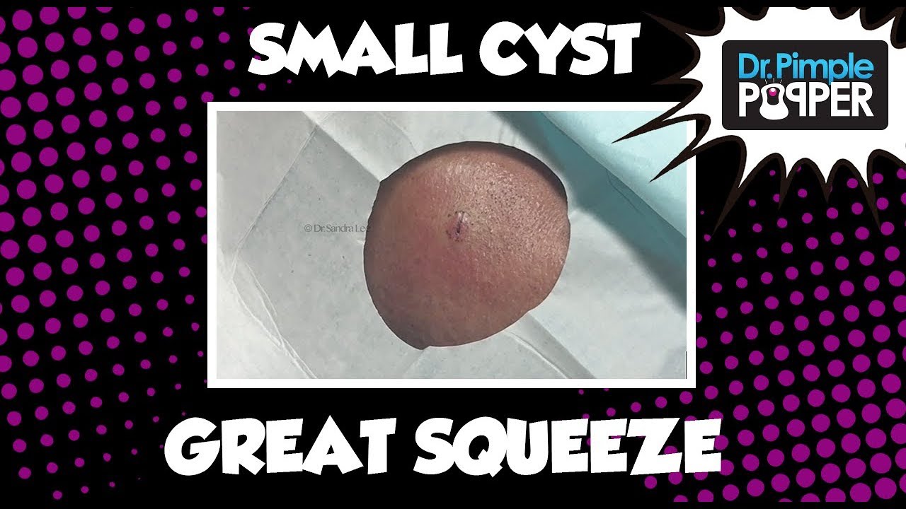 Cheek Anatomical Structure Archives Pimple Popping Videos