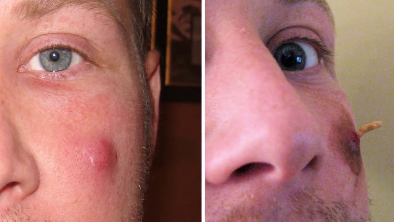 Cheek Cyst Archives Pimple Popping Videos
